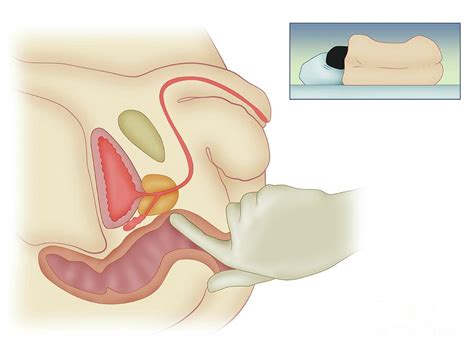 Prostate Examination By Science Photo Library