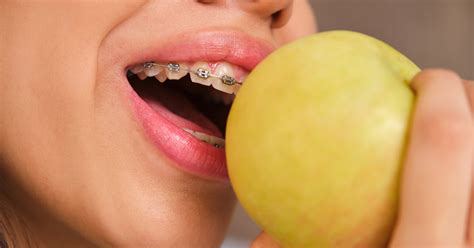 What Snacks Can You Eat With Braces Delicious And Safe Options Smilefit Orthodontics In