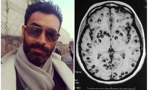 Qué Es La Cisticercosis La Enfermedad Que Habría Matado Al Actor Sebastián Ferrat Infobae