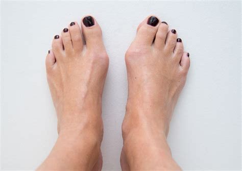 Juanete ¿qué Hacer Cuando Del Dedo Grande Del Pie Se Desplaza Infobae