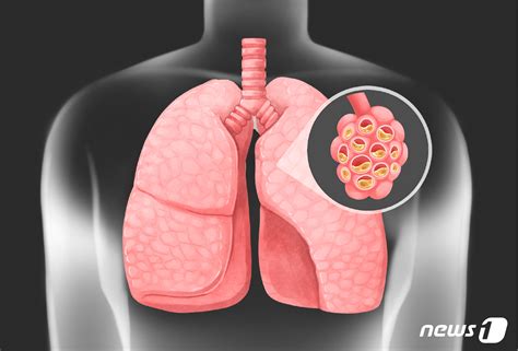폐 딱딱하게 굳는 특발성 폐섬유증 흡입형 치료제 개발 청신호