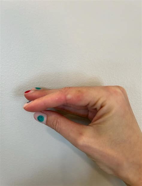 Calcification On The Side Of My Fingers R Scleroderma