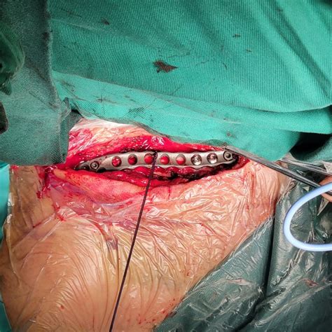 Intraoperative Photograph Of The Open Reduction And Internal Fixation Download Scientific