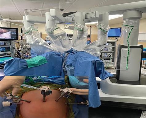 Robotic Assisted Laparoscopic Sacrocolpopexy Clinical Tree