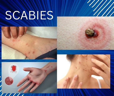 Understanding Scabies Healthy Life With Dr Shaista