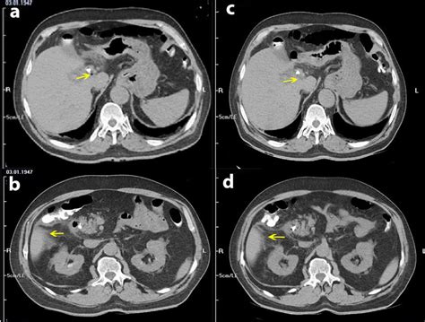 A Partially Regression Of Free Air At The First Control Ct Scan B