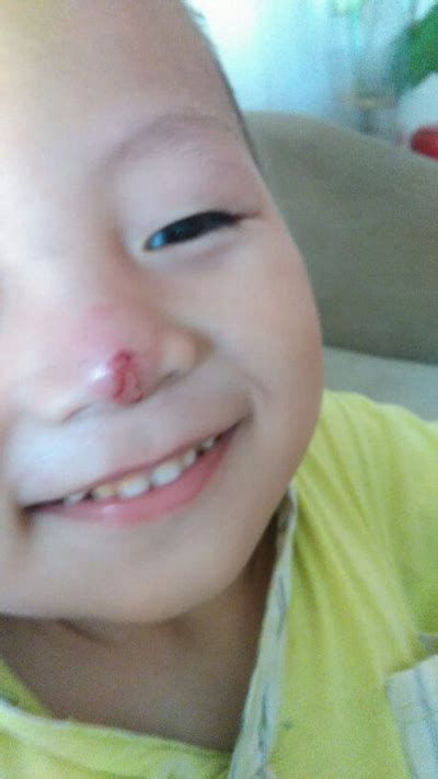 鼻子上长脓包 45 有来医生