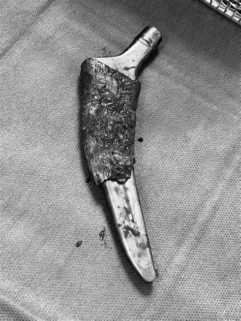 Watson Extraction System On Linkedin Aahks2023 Jointreplacement Arthroplasty Orthopedics