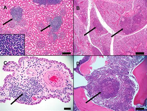 Multifocal Lymphoplasmacytic And Lymphofollicular Inflammation Download Scientific Diagram