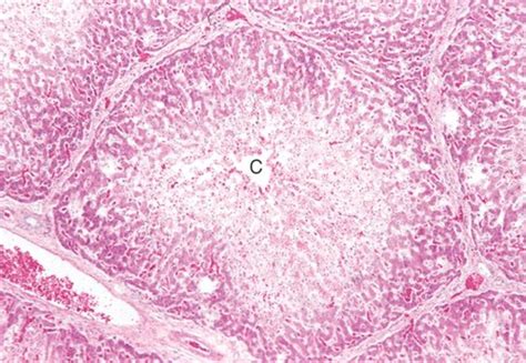 Lec 03 Clinical Management Of Acetaminophen Apap Toxicity Flashcards Quizlet