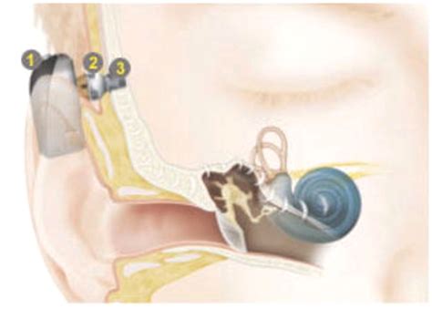 Management Of Conductive Hearing Loss With Implantable Bone Conduction Devices Operative