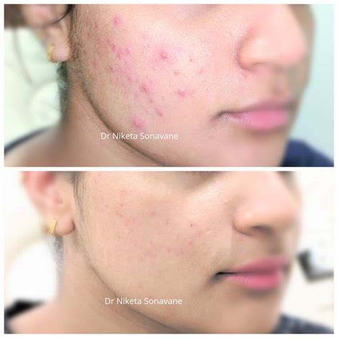 Acne Scar Treatment In Mumbai Cost Before After Results Laser