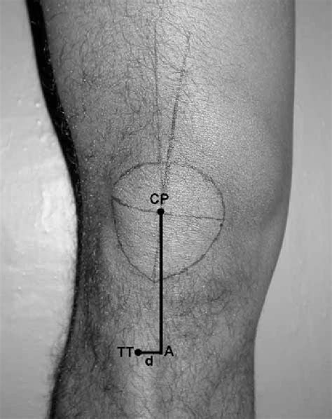Determination Of The Relative Lateral Placement Of The Tibial Download Scientific Diagram