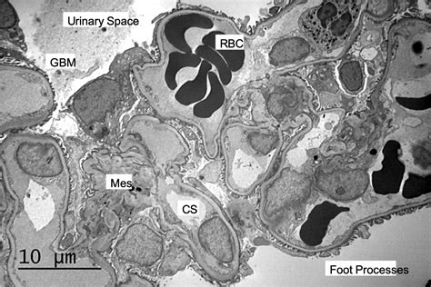 Mesangial Deposits American Society Of Pediatric Nephrology Aspn