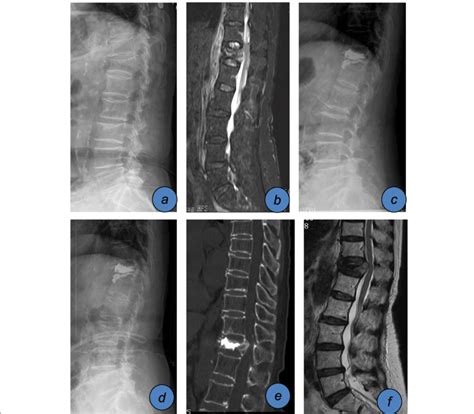 Compression Fracture Diagram