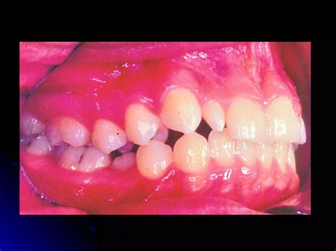 Classification Of Normal Occlusion And Malocclusion Ppt Dental Health Diseases And Conditions