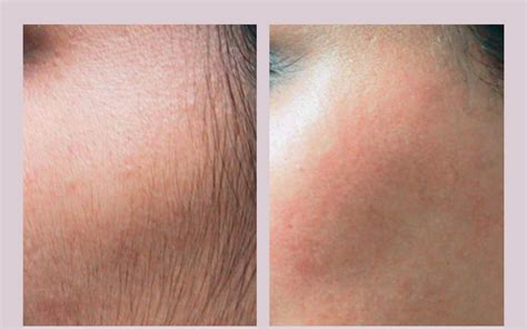 Laser Hair Removal Archives Greenwich Medical Spa