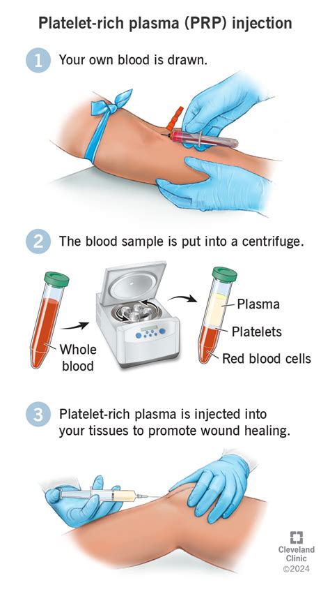 Platelet Rich Plasma Platelet Rich Plasma Prp Therapy Medi Tresse