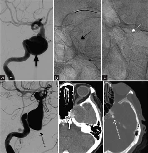 A 78 Year Old Female With Diplopia A Angiogram Showing A Large