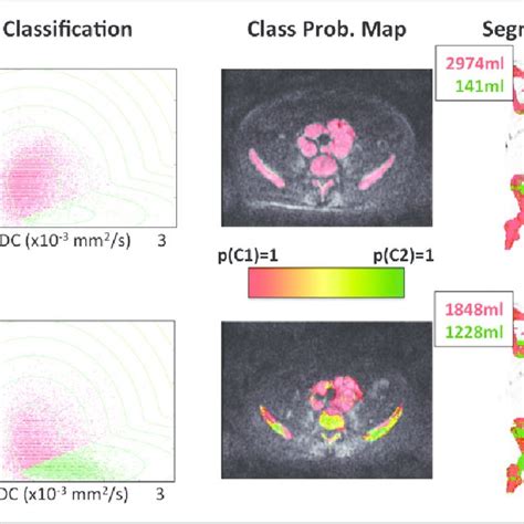 Image Analysis For A Prostate Patient Bone Metastases With No