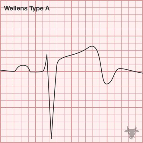 Glossary Ecg Stampede