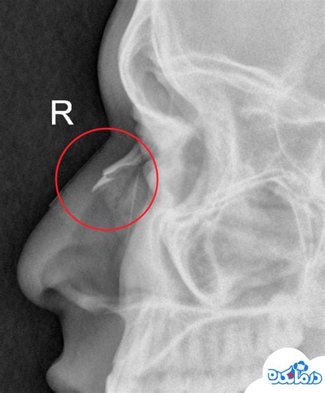 شکستگی بینی؛ دلایل، علائم، انواع، روش تشخیص و درمان درمانکده