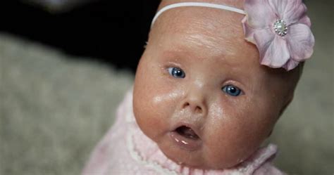 Harlequin Ichthyosis Survivor