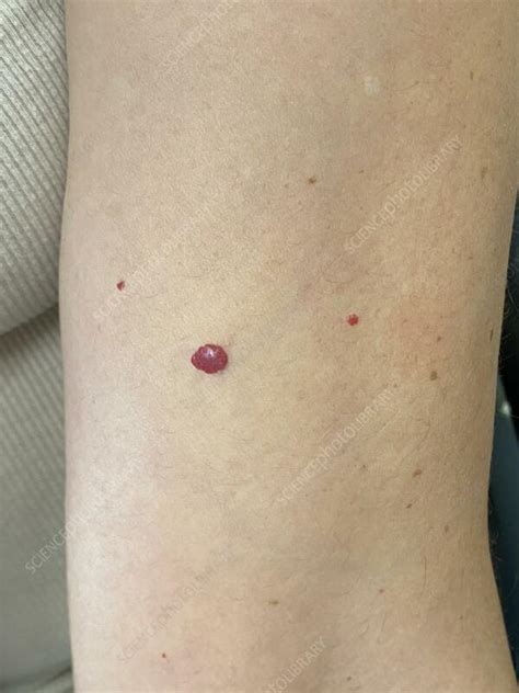 Haemangioma Stock Image C060 4414 Science Photo Library
