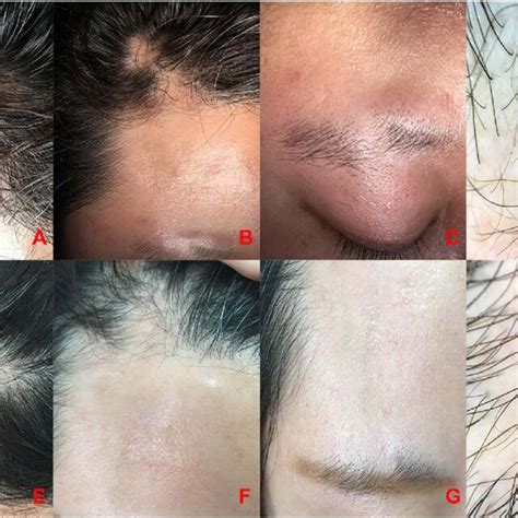 Clinical And Dermoscopy Findings A Atrophic Linear Patch Of Alopecia