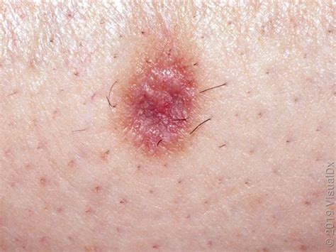 Dermatofibroma Pictures Causes And Removal Goodrx