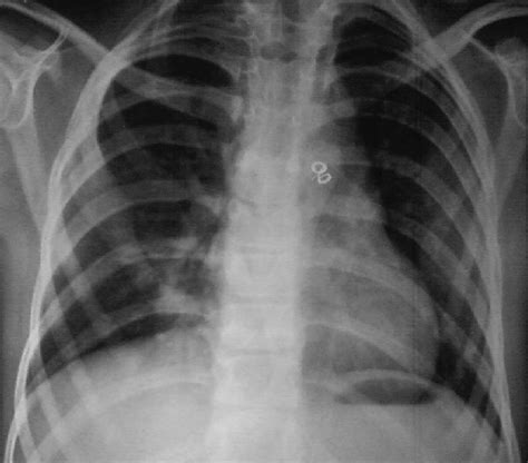 Chest X Ray Showing The Old PDA Clip In Place Download Scientific Diagram