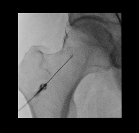 Hip Injection Disambiguation Radiology Reference Article
