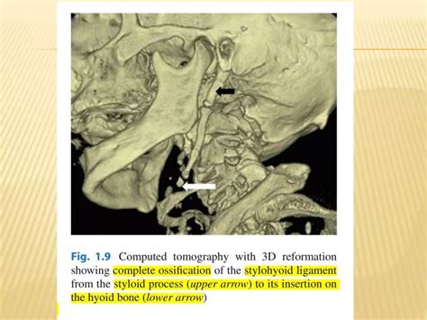 Temporal Bone Mastoid Anatomy Arjun Antony Graison PPTX