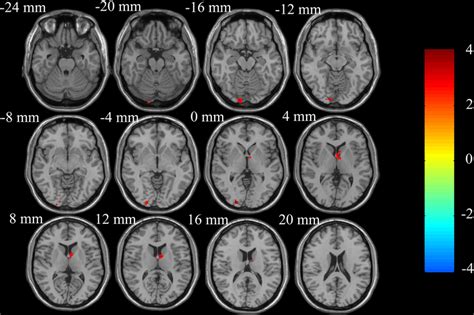 Alff Analysis Of Resting‐state Brain Activity For A Carriers Vs Download Scientific Diagram