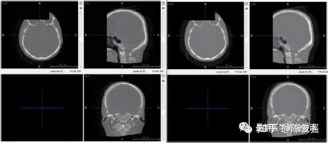 Synthrad2023——放射治疗的ct合成 知乎