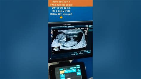Fetal Gender Determination On Ultrasound Determining The Sex Of A
