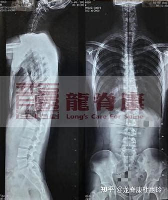 成年人脊柱侧弯参加施罗斯强化班能改善吗 知乎