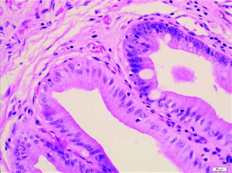 Reactive Atypia In Gallbladder Epithelium Nearby Intestinal Metaplasia