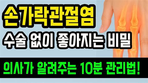 손가락 관절염 수술 없이 좋아지는 비밀 의사가 알려주는 관리법 Youtube