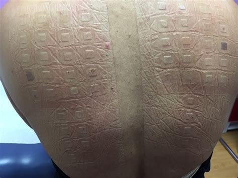 Patch Testing For Chemical Allergies ExpressCare Guam Clinic Doctors For Medical Treatments