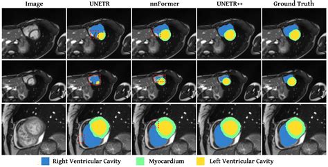 Unetr Delving Into Efficient And Accurate 3d Medical Image Segmentation