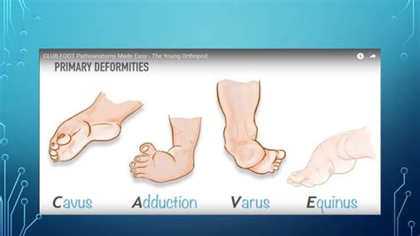 Club Foot Congenital Disorders Pediatrics Pptx Physical Therapy