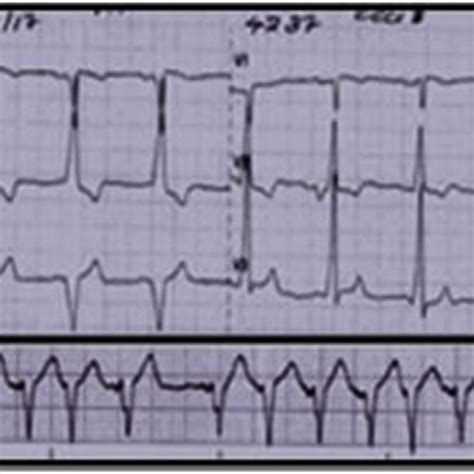 Ecg Demonstrating Wpw Type B Pattern And Atrial Fibrillation Download Scientific Diagram