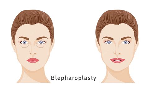Premium Vector Blepharoplasty