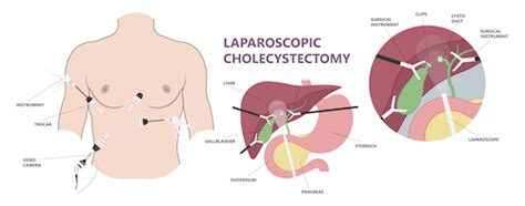 What To Expect After Gallbladder Removal The Surgical Clinic