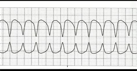 Float Nurse Pulseless Vf Vt Part 1