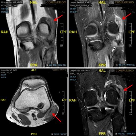 Desmoid Fibromatosis Associated With Endobutton Use For Anterior