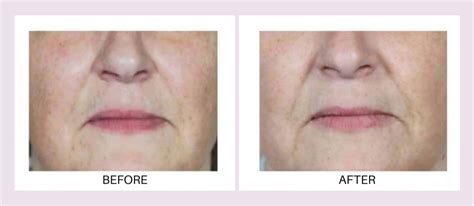 Before And After See How Nctf Takes Years Off Your Face Bella Pelle