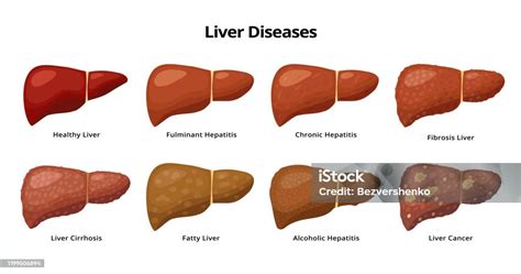 건강한 간 및 간 질환 지방 간 간염 섬유증 간경변 알코올 성 간염 간암 흰색 배경에 고립 된 의료 인포 그래픽 요소 간 내부 기관에 대한 스톡 벡터 아트 및 기타 이미지