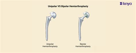 Unipolar Vs Bipolar Hemiarthroplasty Understanding The Differences Knya